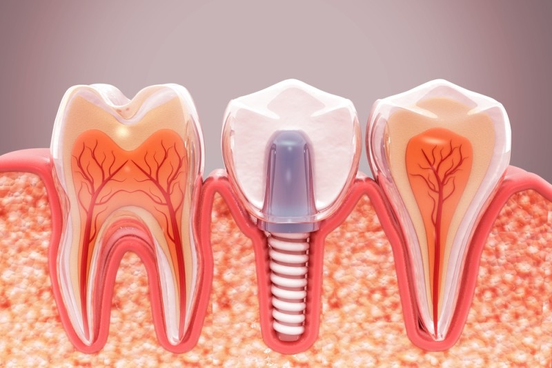Implant dentar - Ghidul complet